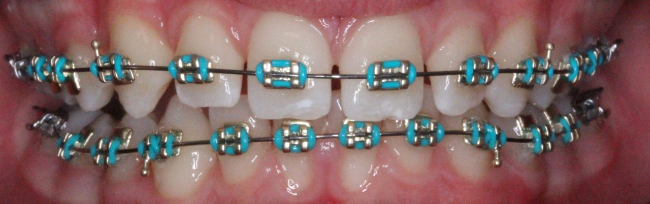 Braces. - Treatments - grin. orthodontics